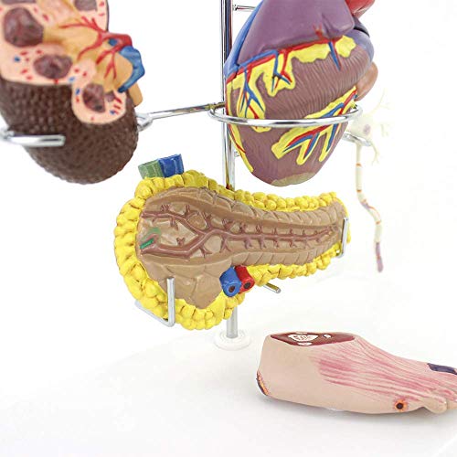 Diabetes Pathology Anatomical Model - 8-Part Teaching Aid