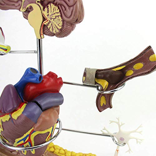 Diabetes Pathology Anatomical Model - 8-Part Teaching Aid