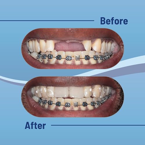 OrVance Aligner Pontics | Temporary Tooth Replacement for Aligner Tray ...